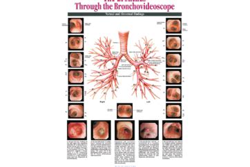 Bronchial Tree Anatomy Bronchoscopy