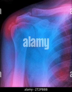 Calcific Tendinitis X Ray Stock Photo Alamy