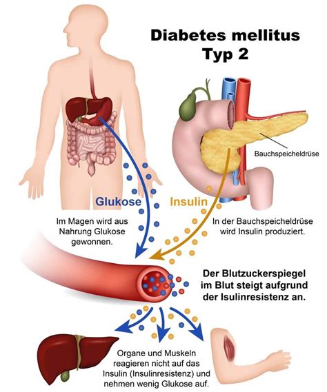 Diabetes Symptome Ursachen Und Behandlung Diabetes