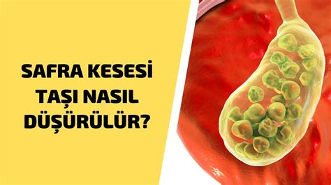 Safra Kesesi Taşı Nasıl Düşürülür Safra İltihabına Ne İyi Gelir YouTube