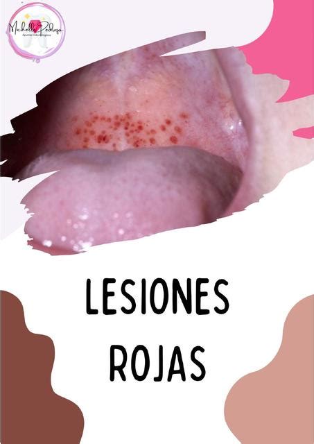 Lesiones Rojas Ii Michelle Pedroza Udocz