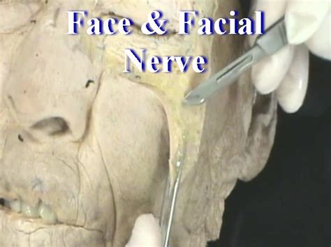 Mandibular Nerve Cadaver