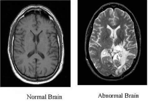 figure 2 from brain tumor classification using convolutional neural network with neutrosophy
