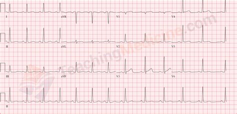Ecg Demonstrating Normal Sinus Rhythm Normal Axis Non Specific Images