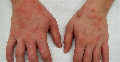 Eczéma atopique et eczéma de contact Dossier