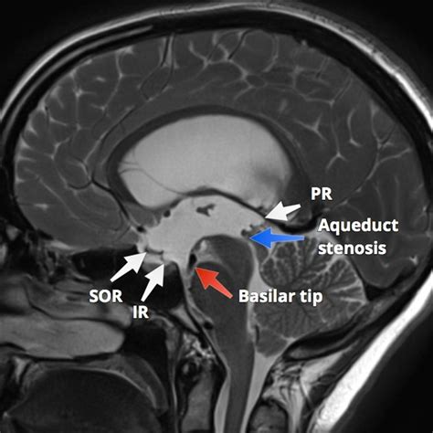 Aqueduct Stenosis Radiology Case Radiopaedia Org Radiology Brain