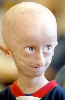 Salute La Progeria Una Rarissima Malattia Che Imprigiona I Bimbi Nel