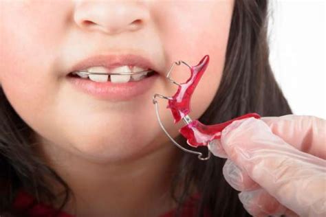 How A Palatal Expander Works Valley Ranch Orthodontics Irving Texas