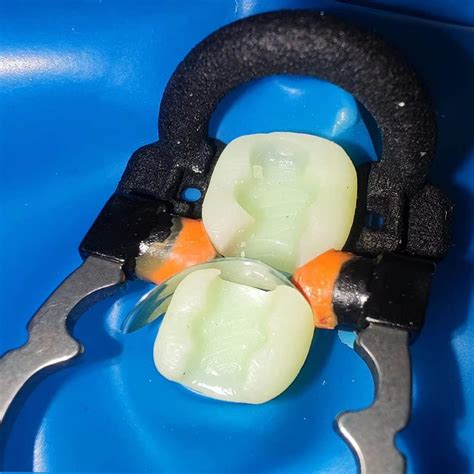Windplusya Sistema De Matriz Seccional Dental Juego De Anillos Y Bandas