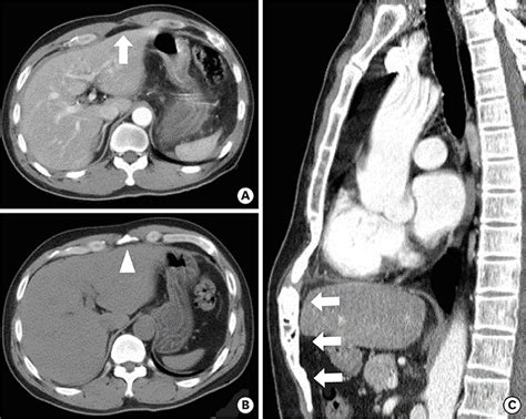 Heterotopic Ossification Of The Xiphoid Process After Abdominal Surgery