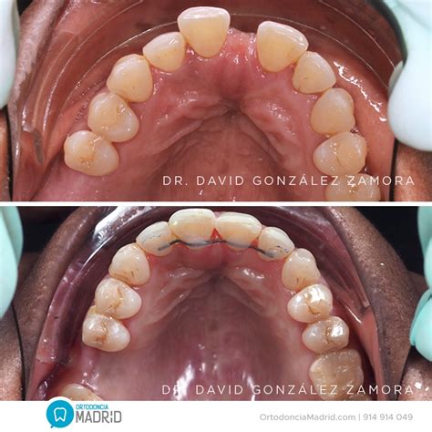 Diastema Biprotrusión Ortodoncia Madrid