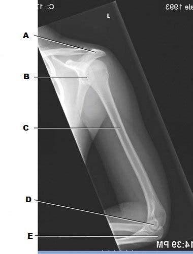 Upper Extremity Image Review Flashcards Quizlet