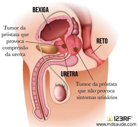 Câncer de próstata o que é sintomas causas e tratamento VEJA VÍDEO