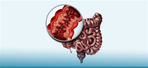 Atl Tico Suavemente Ficar De P Perfura O Intestinal Causas