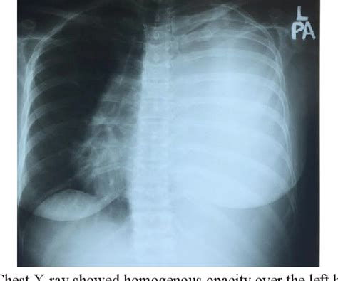 Figure 1 From Primary Malignant Melanoma Of The Pleura A Rare Case