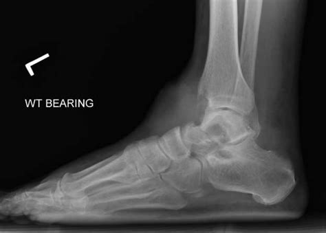 Figure 1 From Pathologic Talar Neck Fracture Resulting From Myxoid