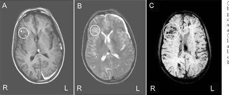 Diffuse Axonal Injury Mri Diffuse Axonal Injury Dai Mri Online