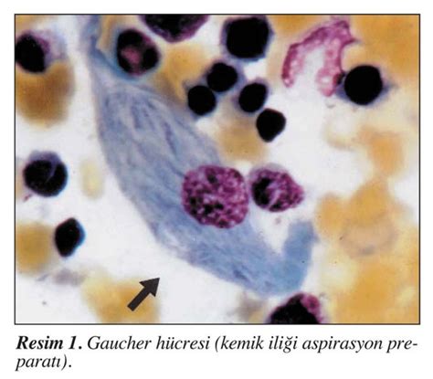 Gaucher Hastalığı Nedir Belirtisi ve Tedavisi