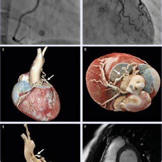 Vieussens Arterial Ring On Multimodality Imaging A Selective