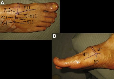 Sprain Of Tarsometatarsal Joint Ligament Of Foot Semantic Scholar