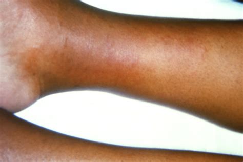 Superficial Thrombophlebitis Arm