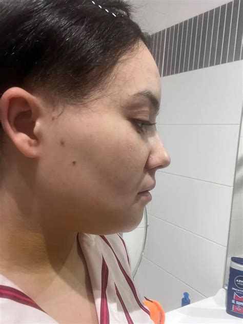Génioplastie à J 6 Chirurgie esthétique du menton génioplastie