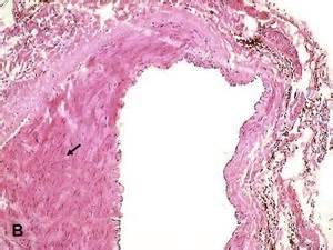 Pathology Outlines Fibromuscular Dysplasia