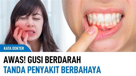 Penyebab Gusi Berdarah Awas Tanda Penyakit Berbahaya Kata Dokter