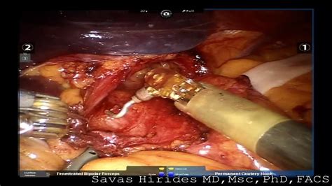 Dr SC Hirides Performing A Robotic Hiatal Hernia Repair Nissen