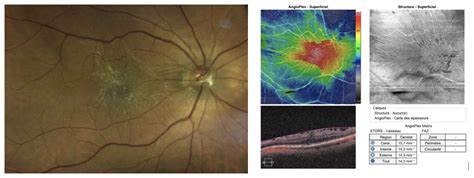 Membrane épi rétinienne membrane épi maculaire Chirurgie