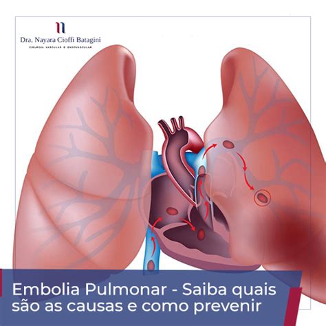 Tromboembolismo Pulmonar Conheça a emoção dos jogos de azar