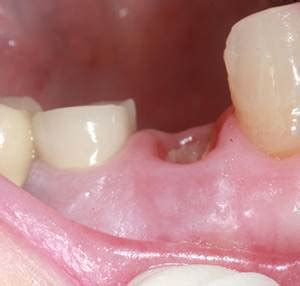 Extraction de dents infectées SoinDentaire