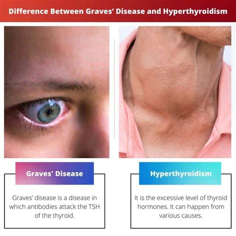Graves Disease Vs Hyperthyroidism Difference And Comparison