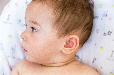 Cómo quitar el sarpullido por calor en bebés Pasion paternal
