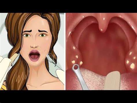 ASMR Extreme Tonsil Stone Treatment Satisfying Tonsil Stone Removal