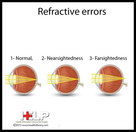 Refractive Errors Eye Pinterest