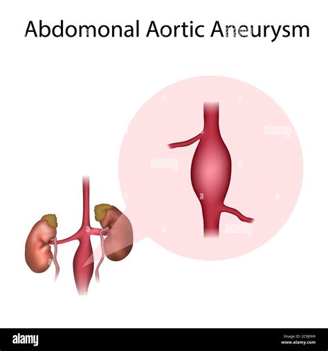 Aneurisma de aorta abdominal Imágenes recortadas de stock Alamy
