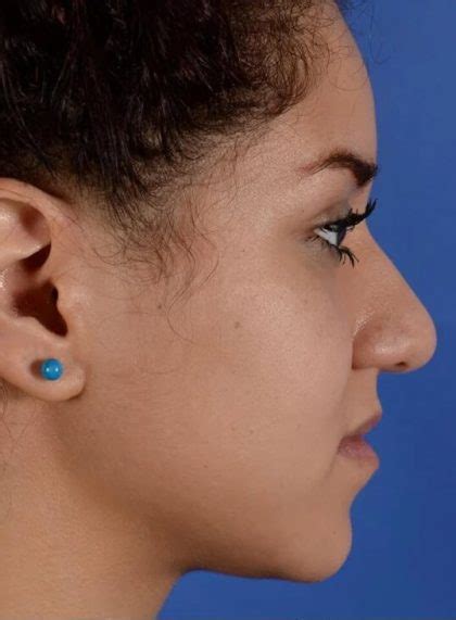 Patient 2114 Buccal Fat Removal Before And After Photos Englewood