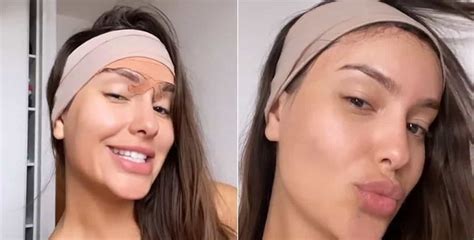 Thais Braz mostra testa sem curativo pela primeira vez após cirurgia de