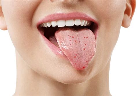 Que Significa La Lengua Blanca Con Puntos Rojos Top Sellers Dakora Co