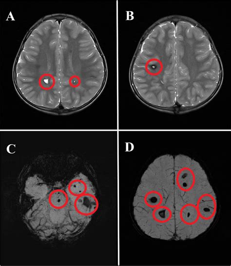 The Abnormal Magnetic Resonance Imaging MRI Of Head A T2WI Showed