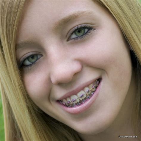 60 Photos Of Teenagers With Braces Robweigners Blog