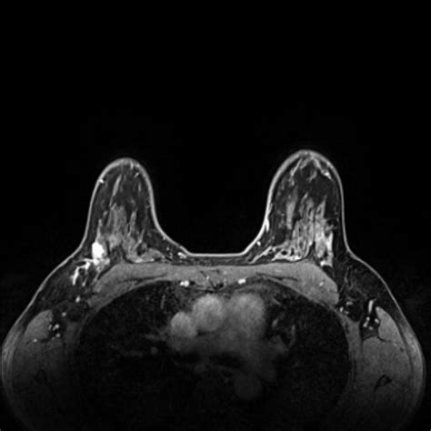Breast Cancer MRI Segment Instance Segmentation Dataset By YOLO