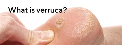 Cryopen Using Cryotherapy For Wart Removal Iv Site
