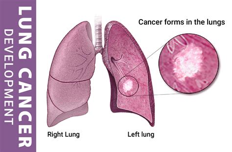 What Is Lung Cancer Types Of Lung Cancer Symptoms And Causes