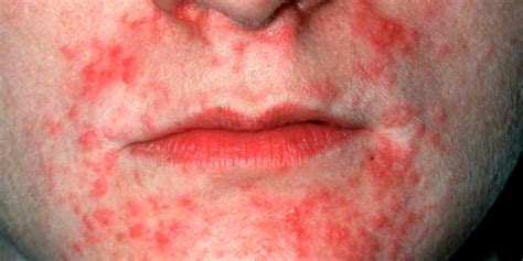 Dermatite Conheça e entenda todos os tipos nesse guia definitivo
