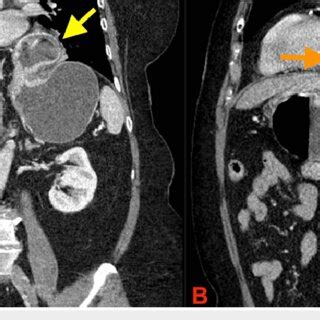 Ct Abdomen And Pelvis With Iv Contrast Demonstrating A Large Hiatal