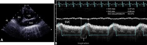 Echocardiographic Applications Of M Mode Ultrasonography In