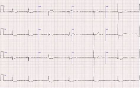 EKG 12 Lead Flashcards Quizlet