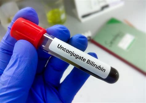 Científico sostenga una muestra de sangre para la prueba de bilirrubina
